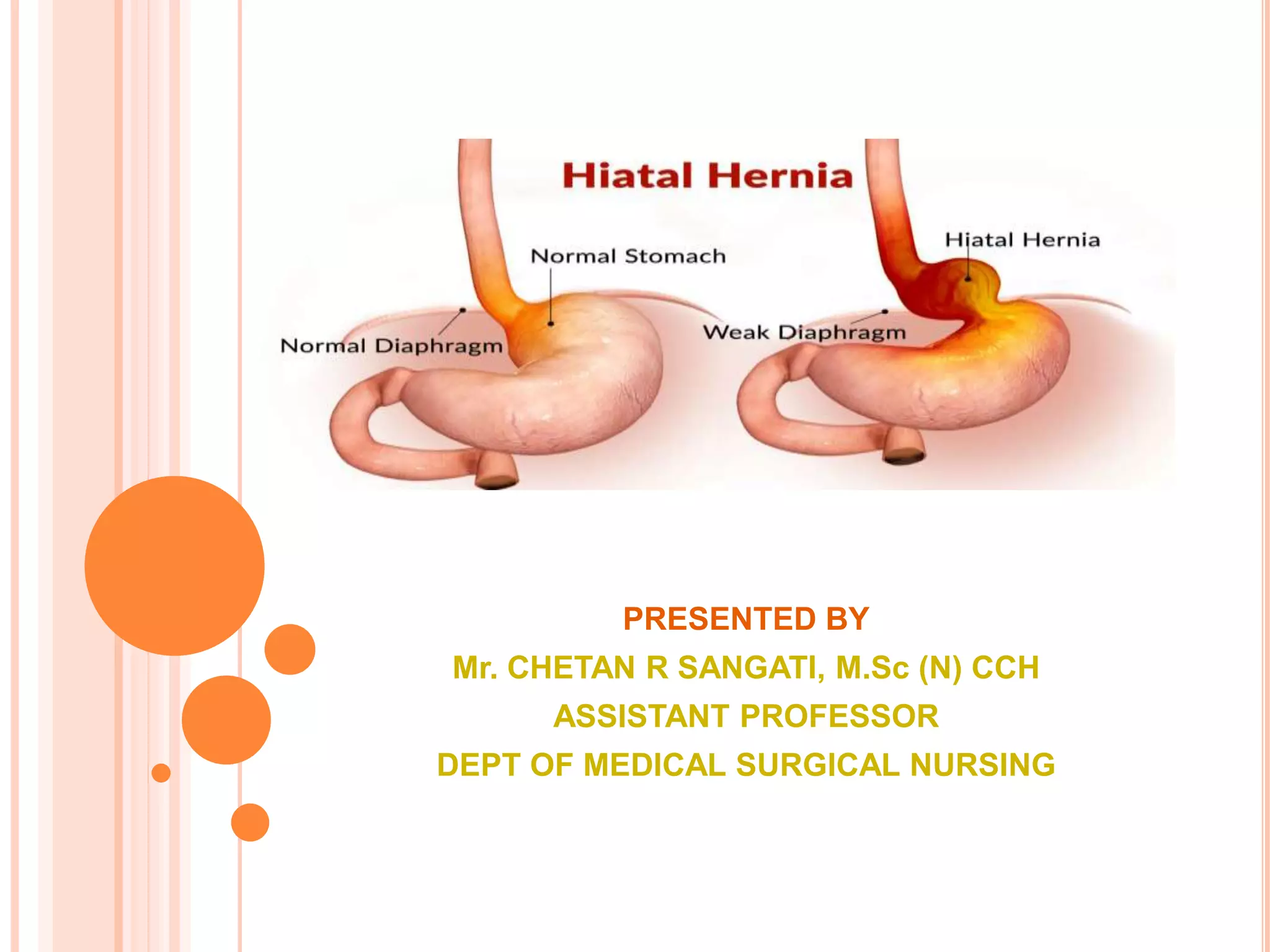 Hiatal Hernia.pptx