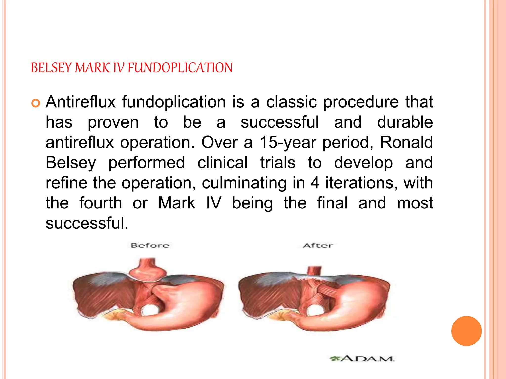 Hiatal Hernia.pptx