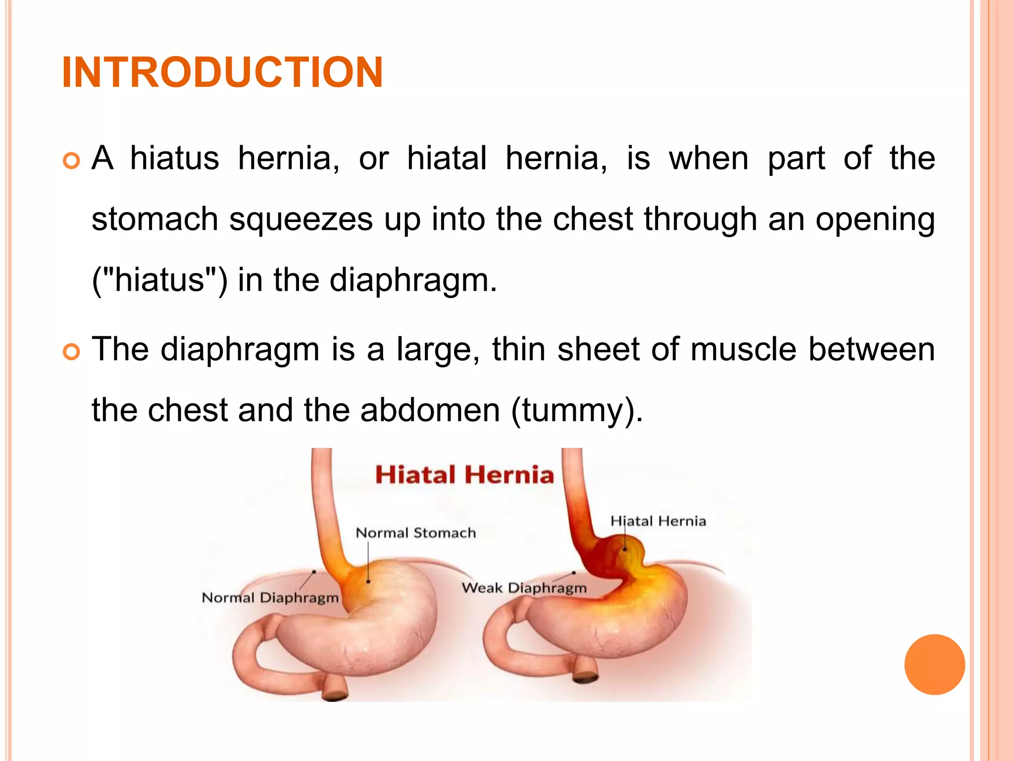 Hiatal Hernia.pptx