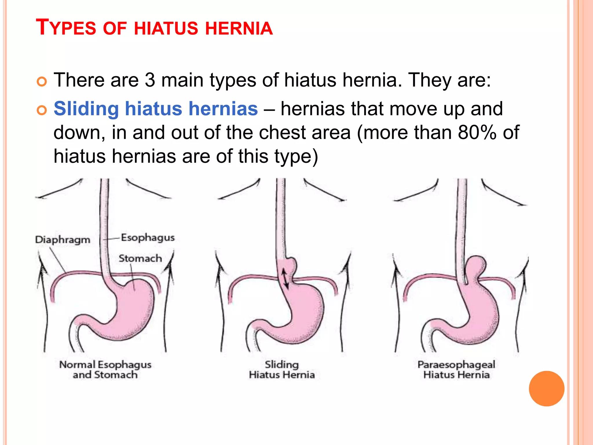 Hiatal Hernia.pptx