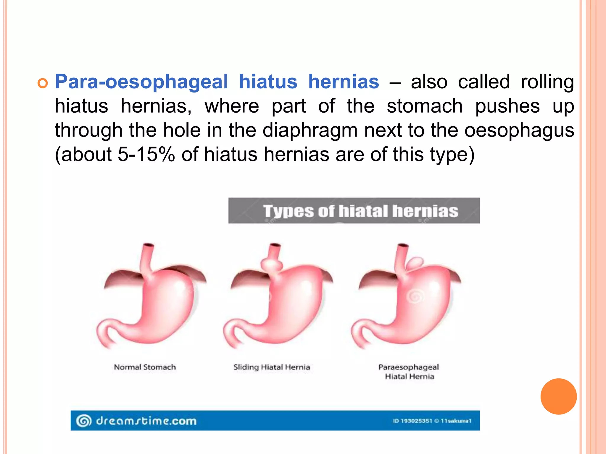 Hiatal Hernia.pptx