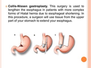 Hiatal Hernia.pptx