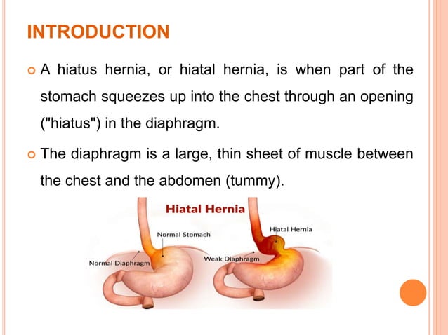 Hiatal Hernia.pptx
