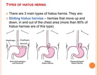 Hiatal Hernia.pptx