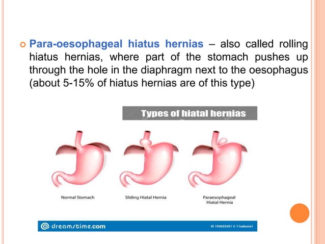 Hiatal Hernia.pptx