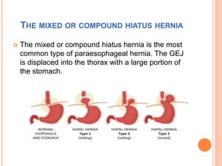 Hiatal Hernia.pptx