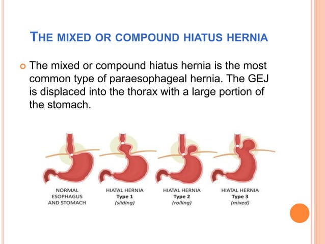 Hiatal Hernia.pptx