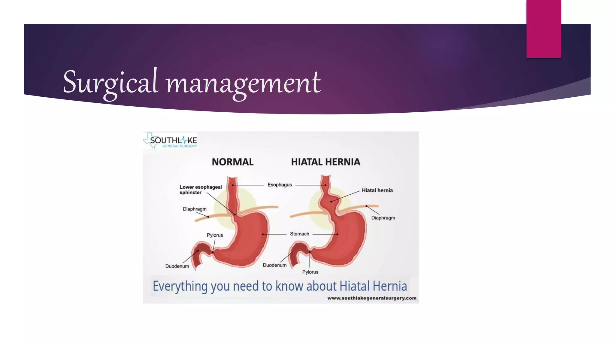 Hiatal hernia.pptx