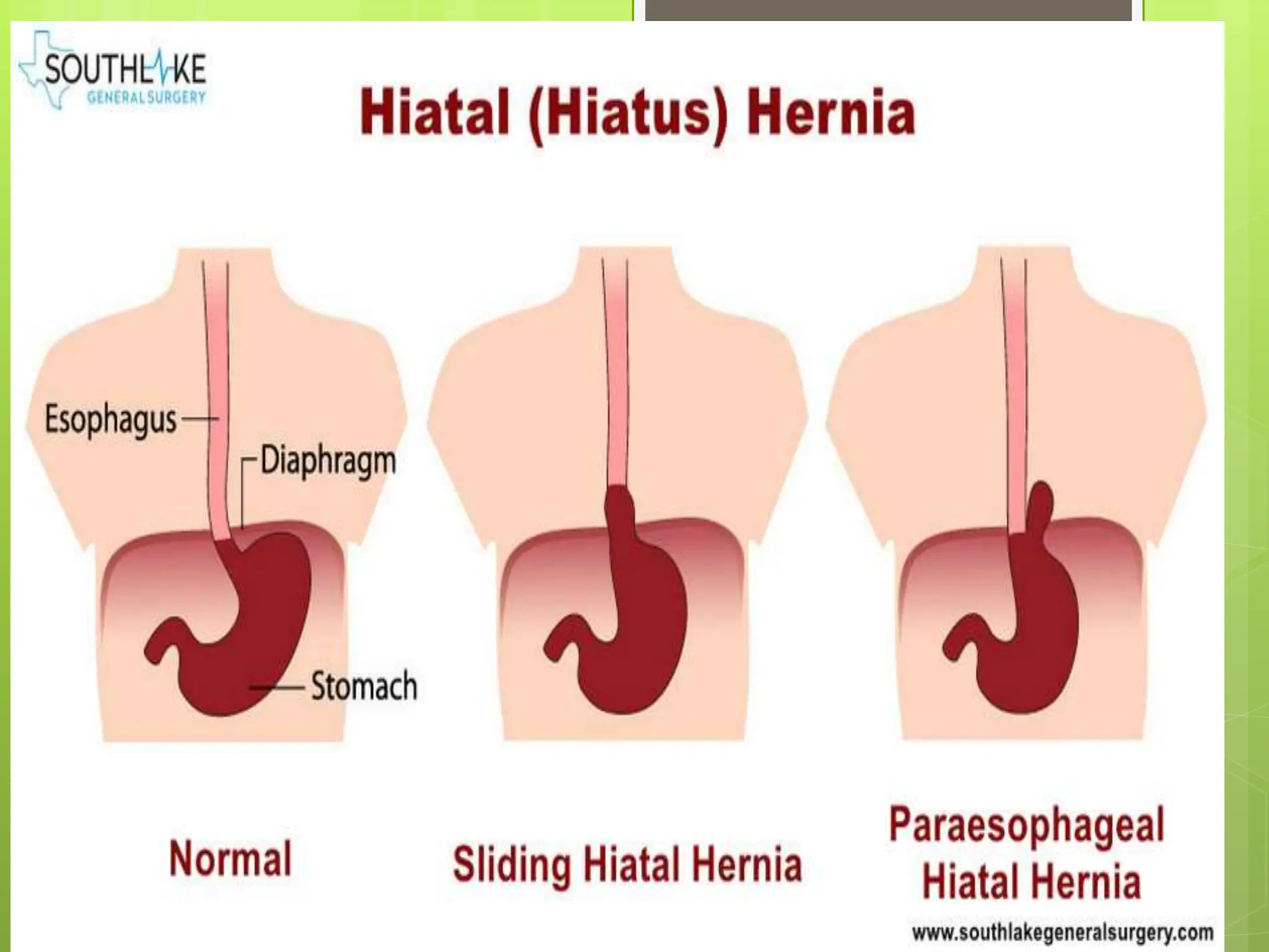 Hiatal Hernia.pptx