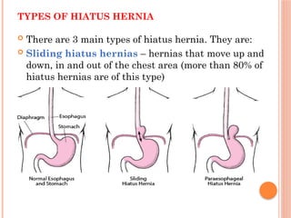 HIATAL HERNIA SURGERY DEPARTMENT TWO.pptx