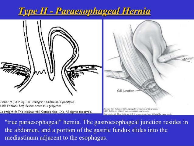 Hiatal Hernias