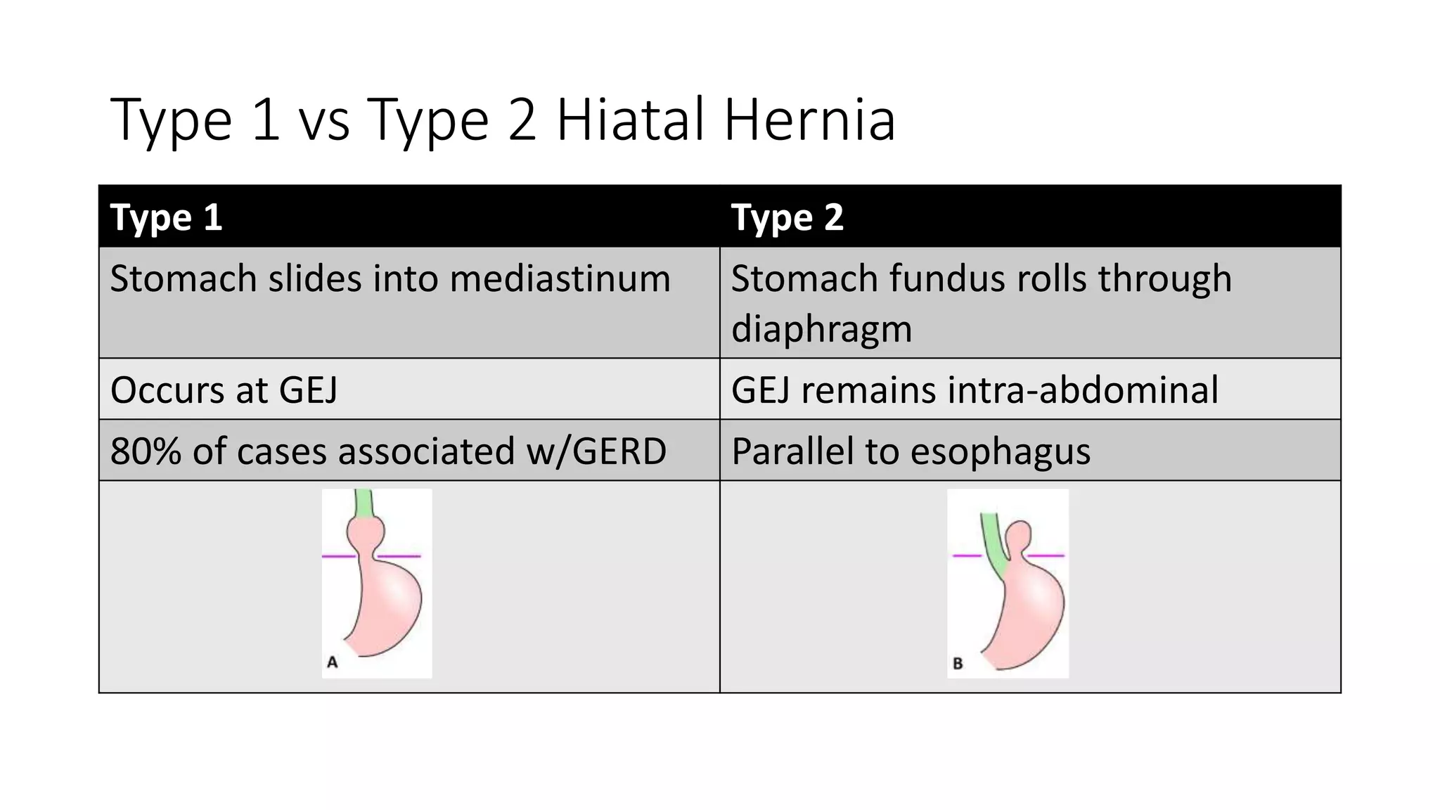 Hiatal hernias | PPTX