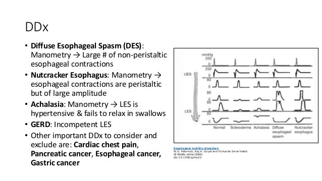 Diffuse Esophageal Spasm Manometry