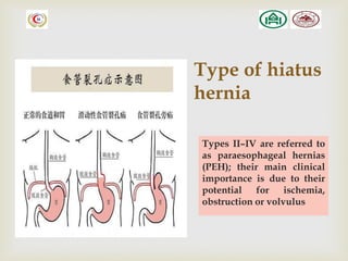 hiatus hernia | PDF