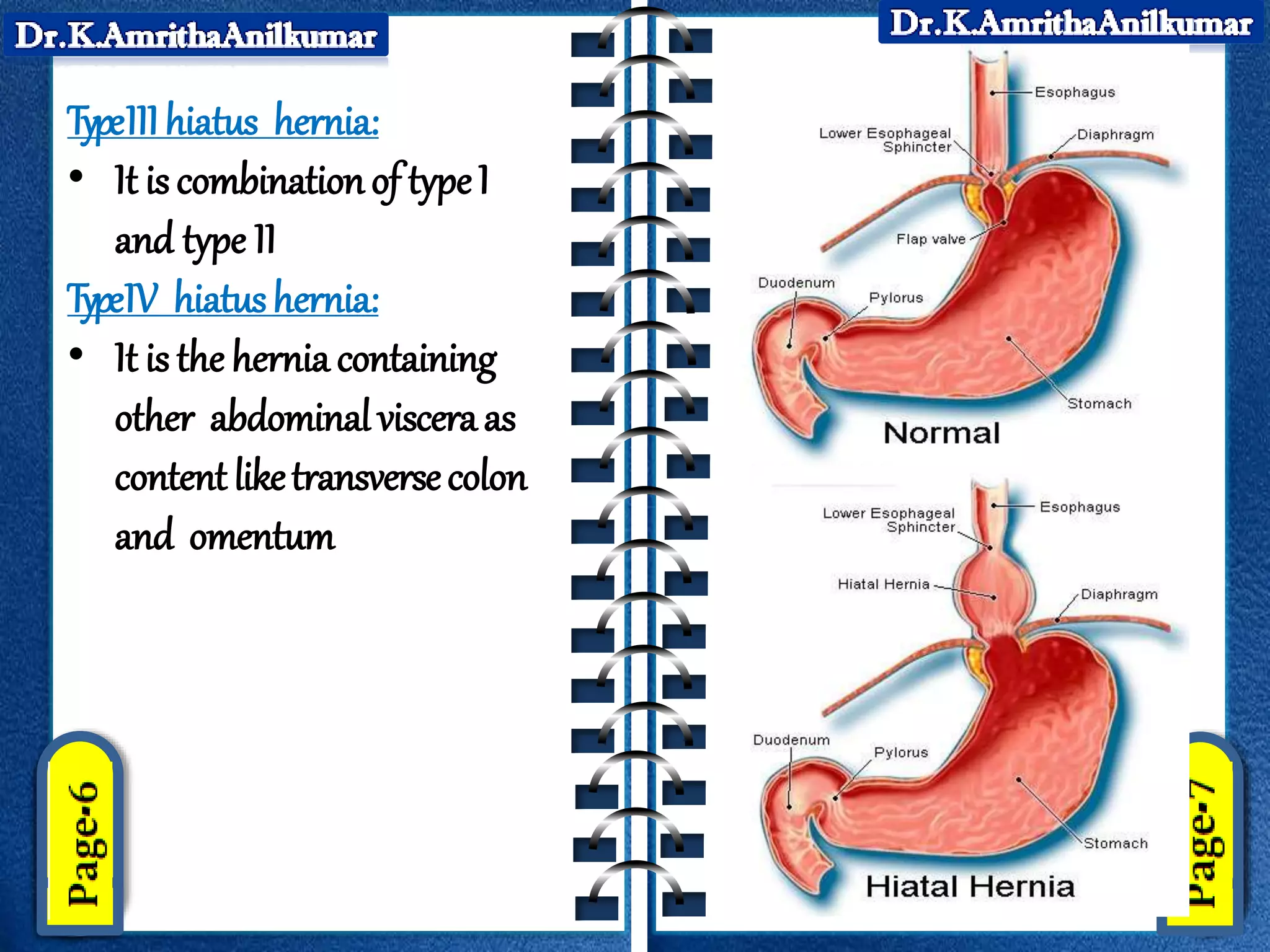 Hiatus hernia by Dr.K.AmrithaAnilkumar | PPT