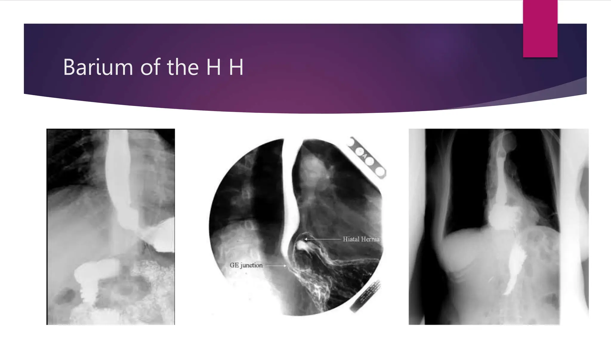 hiatus hernia.pptxmmmmmmmmmmmmmmmmmmmmmmm. | PPTX