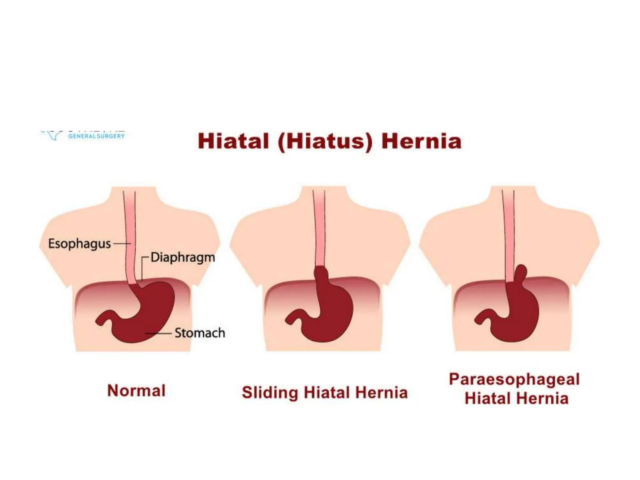 HIATUS HERNIA - types, causes, symptoms & Diet Management | PPT