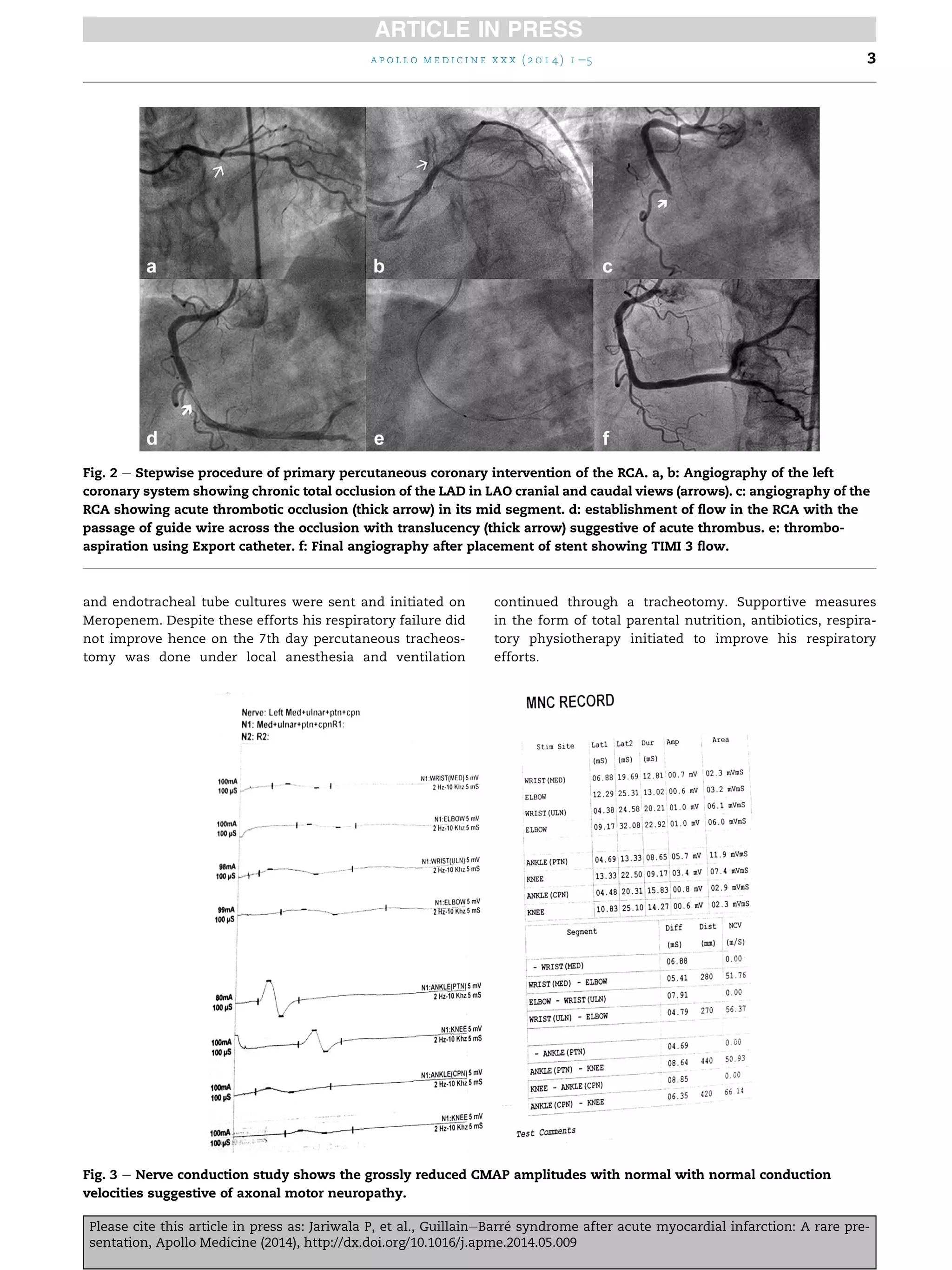 Guillain - Barre syndrome after acute myocardial infarction: A rare ...