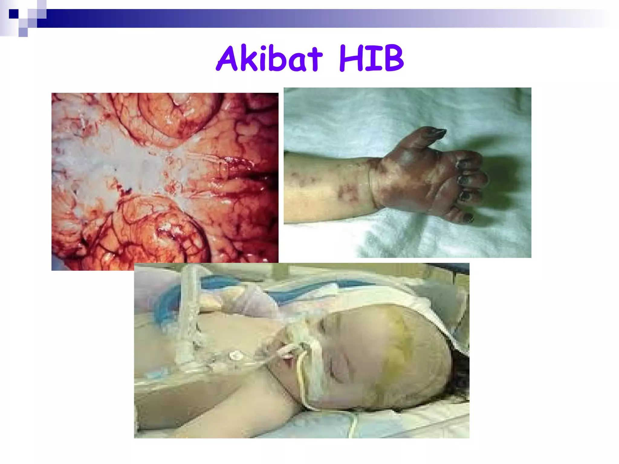 Hib prp t & hib prp-omp | PPT