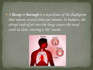 Hiccups! | PPTX