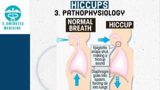 hiccups by 2.5 minutes medicine.pptx