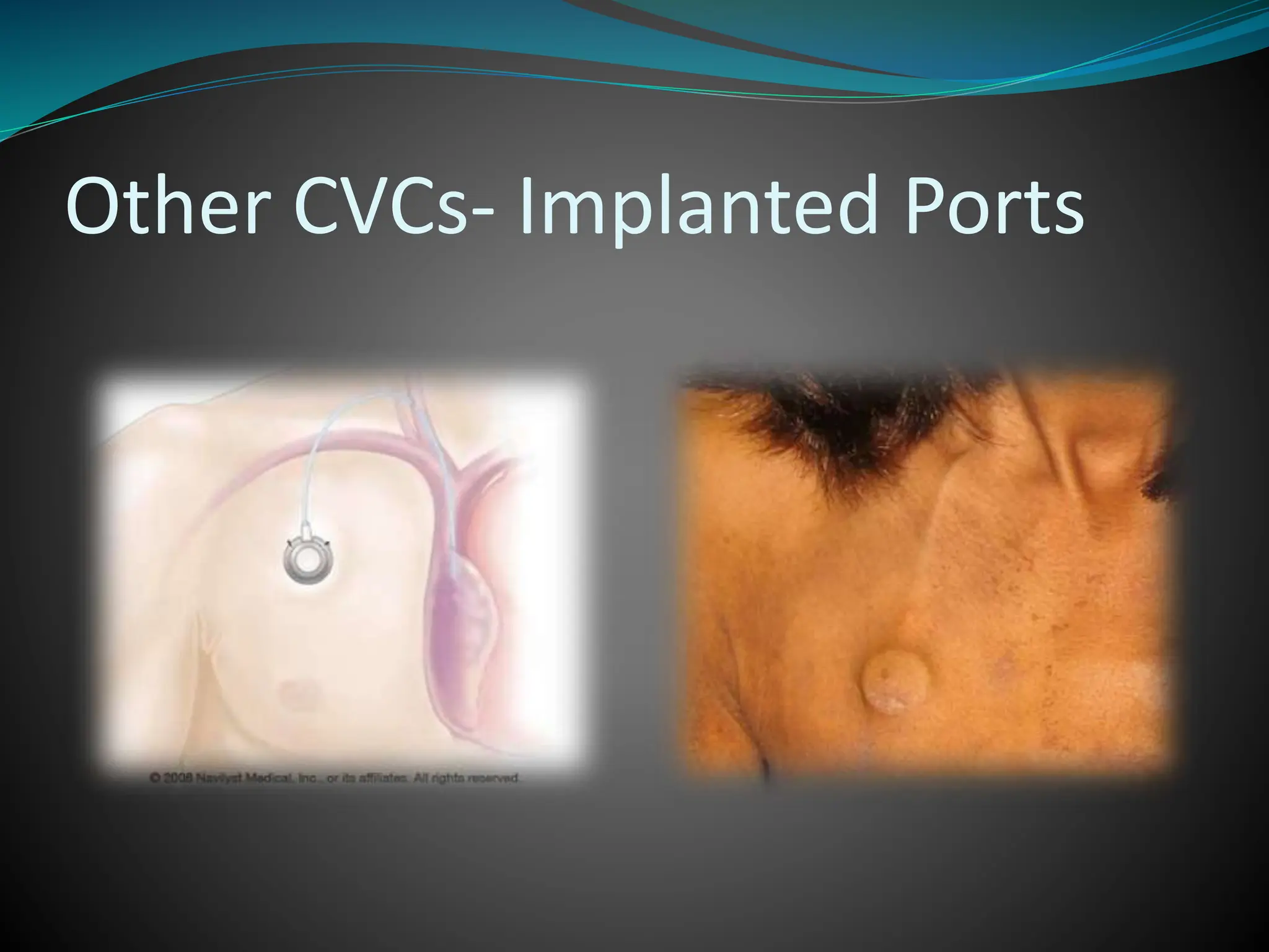 Hickman Catheter- An overview. Details about Hickman, insertion, care ...