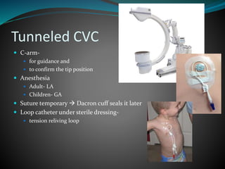 Hickman Catheter- An overview. Details about Hickman, insertion, care ...