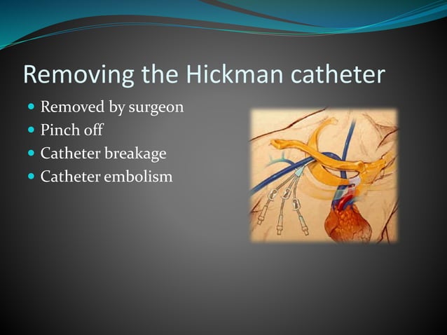 Hickman Catheter- An overview. Details about Hickman, insertion, care ...
