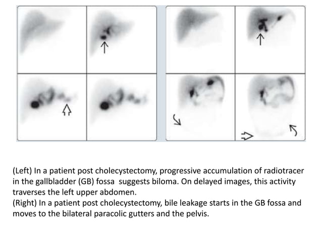 HIDA Scan | PPTX | Digestive Disorders | Diseases and Conditions
