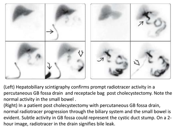 HIDA Scan | PPTX | Digestive Disorders | Diseases and Conditions