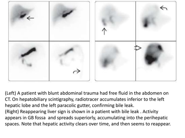 HIDA Scan | PPTX | Digestive Disorders | Diseases and Conditions