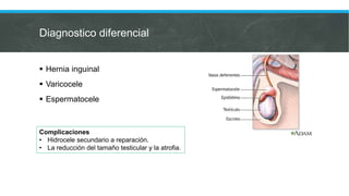 Hidrocele | PPSX