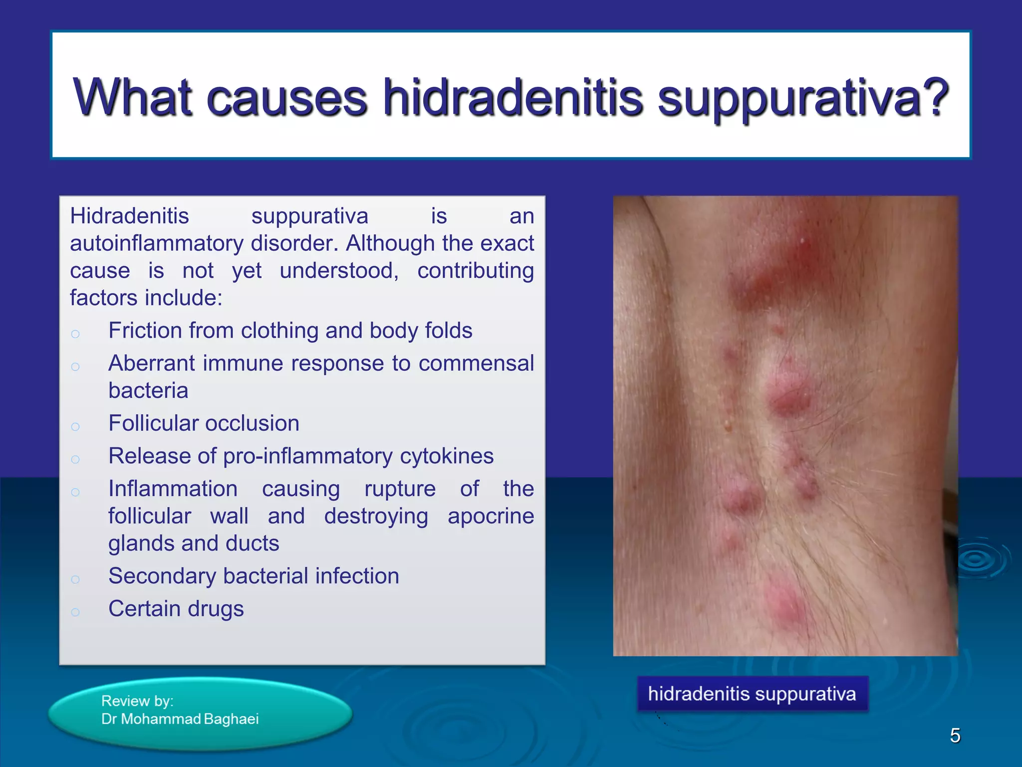 Hidradenitis suppurativa,by Dr Mohammad Baghaei | PDF