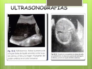 Hidramnios | PPT
