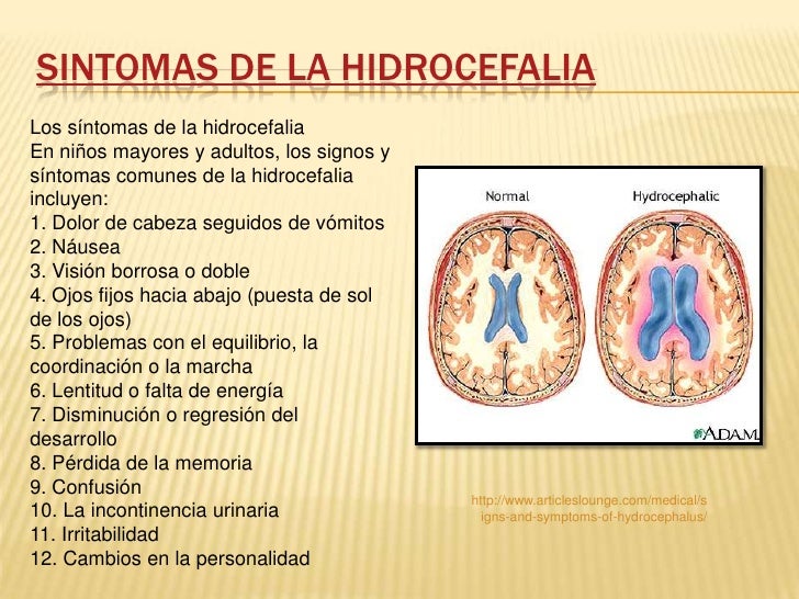 Hidrocefalia
