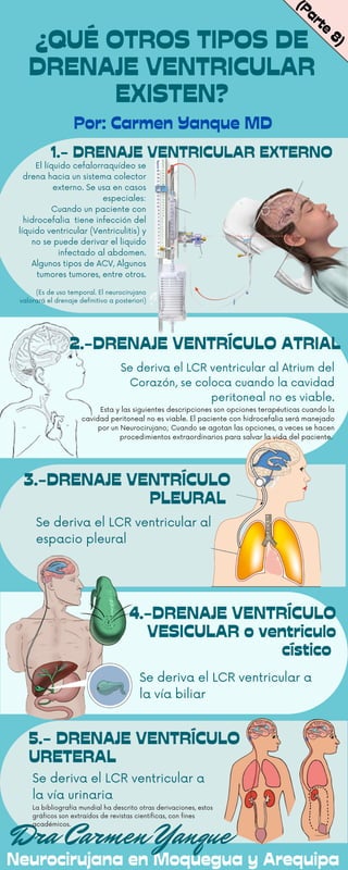 HIDROCEFALIA.pdf