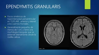 Hidrocefalia imágenes | PPTX