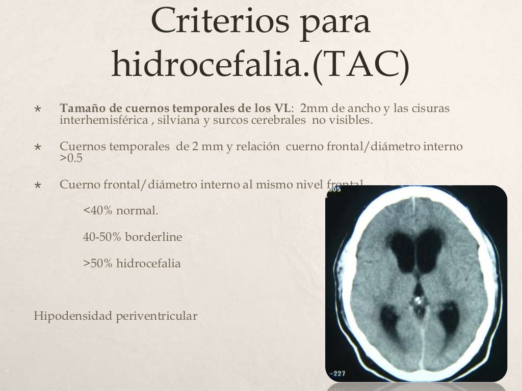 Hidrocefalia e indice de Evans. Arturo Ayala-Arcipreste MD FAANS