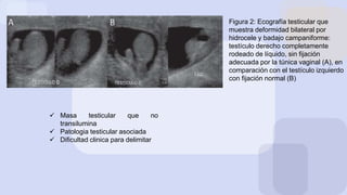 HIDROCELE CONCEPTOS GENERALES Y FISIOPATOLOGIA | PPTX