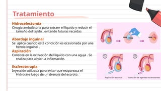 Hidrocele. acumulación de líquido en el interior del escroto que rodea ...