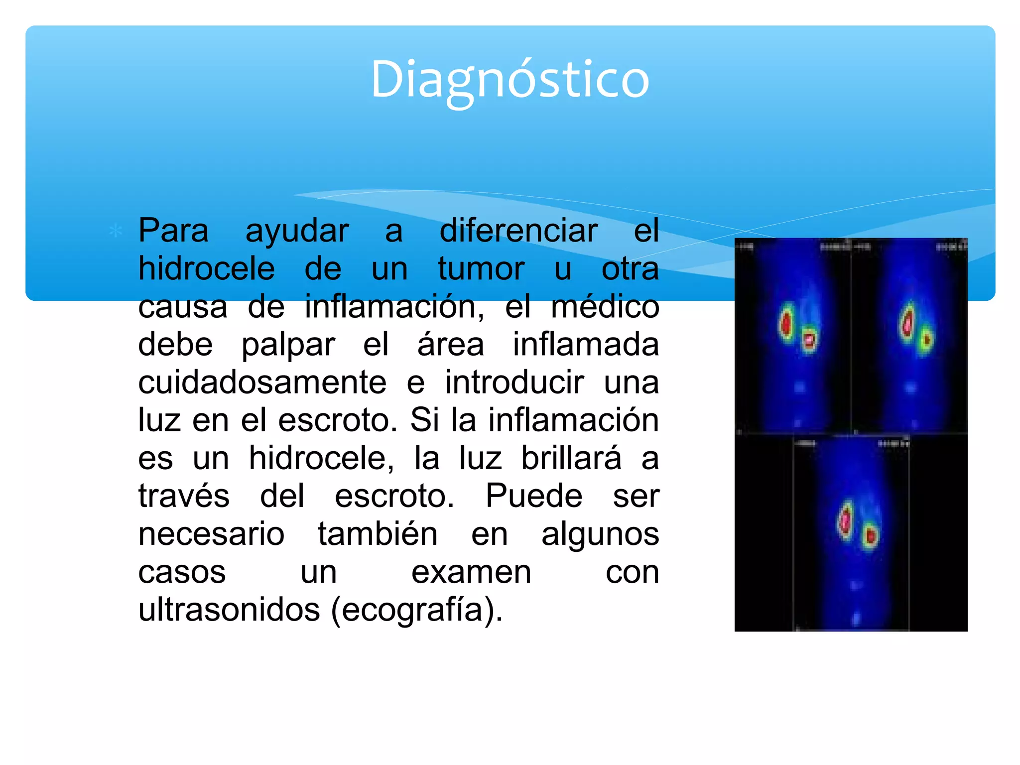 Hidrocele.ppt rosa | PPT