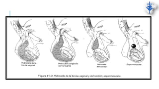 Hidrocele y varicocele | PPTX