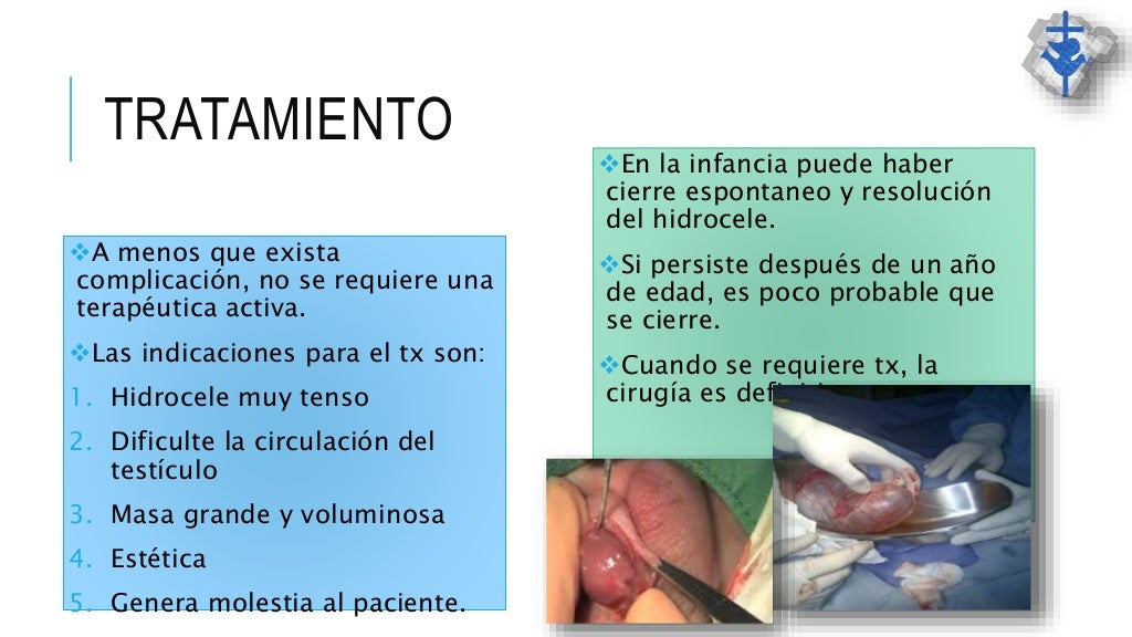 Hidrocele y varicocele