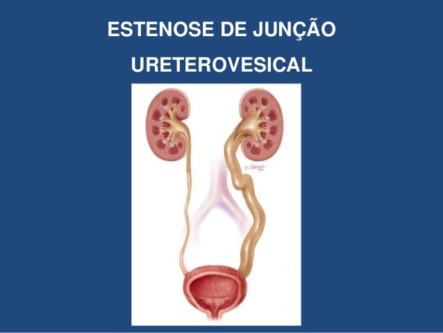 Hidronefrose fetal.