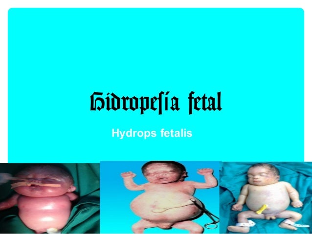 Hidrop Fetal Nieves Fernandez
