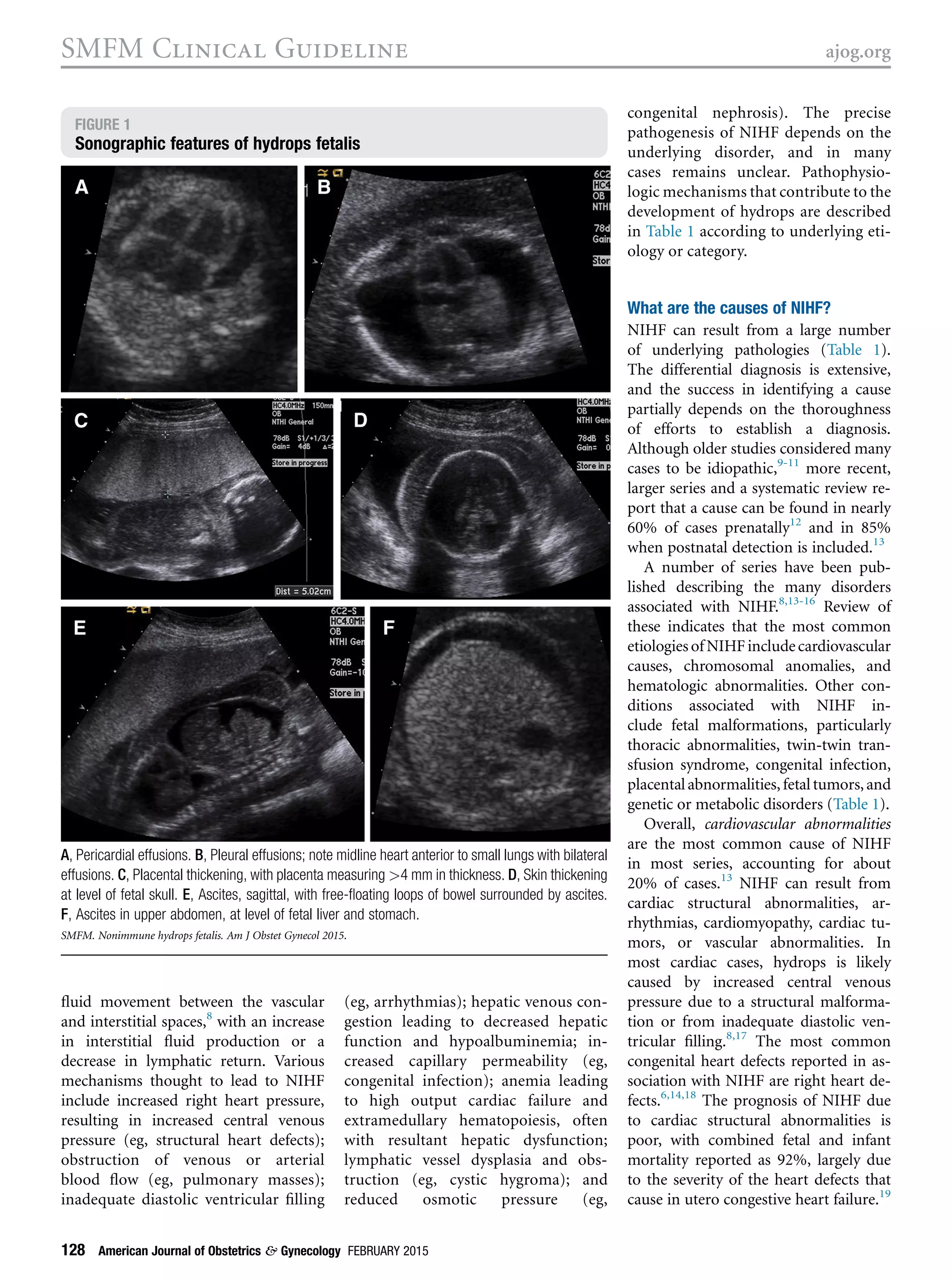 Hidrops fetal no inmune | PDF