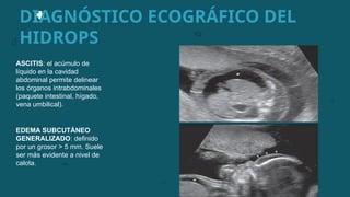 HIDROPS FETAL.pptx sensibilizacion maternofetal rh | PPTX