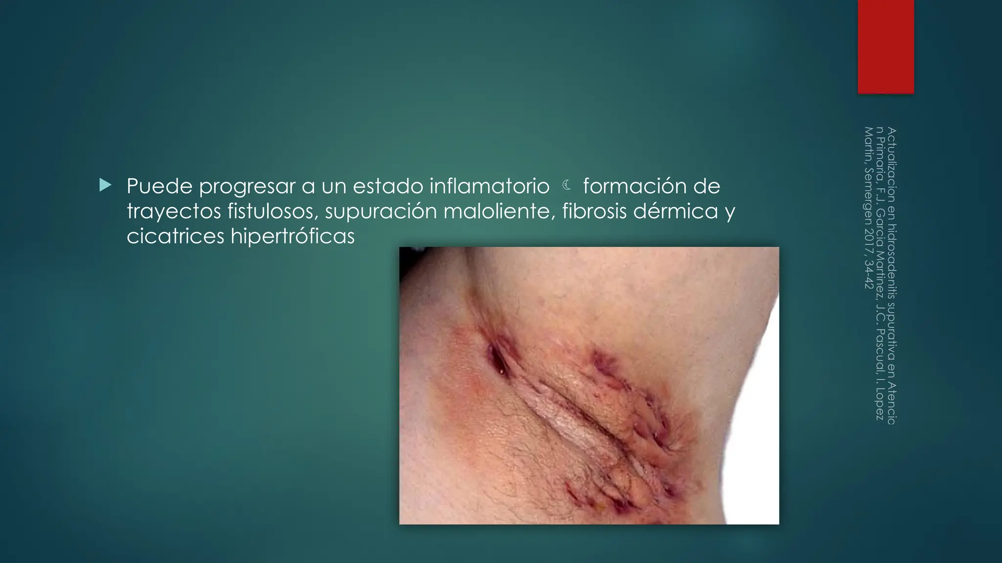 Hidrosadenitis supurativa infeccion.pptx