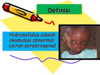 Hidrosefalus | PPT