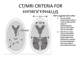 HIDROSEFALUS.pptx